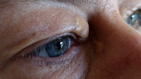Bilateral Xanthelasma