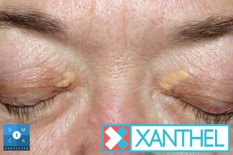 Xanthelasma Images and Pictures
