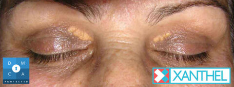 Xanthelasma Images and Pictures