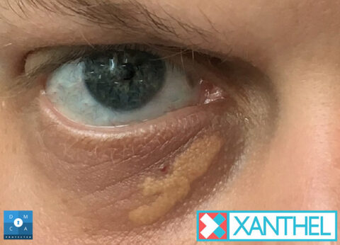 Xanthelasma Images and Pictures