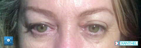 Before and after treatment - Xanthel