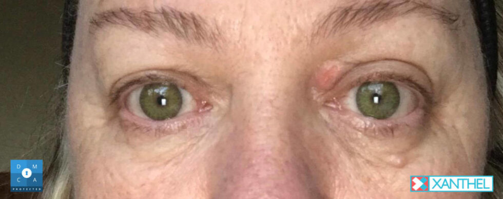 Before and after treatment - Xanthel