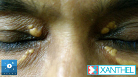 Xanthelasma Images and Pictures