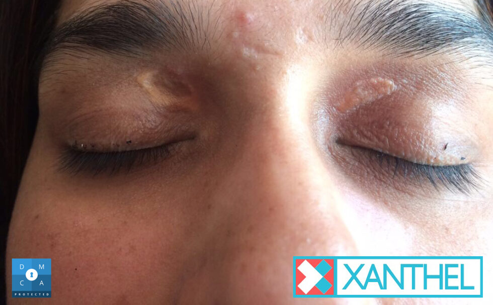 Xanthelasma Images and Pictures