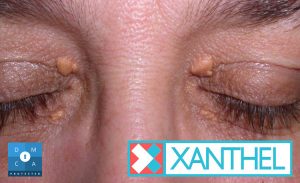 Xanthelasma Photo Gallery | Pictures by Xanthel®