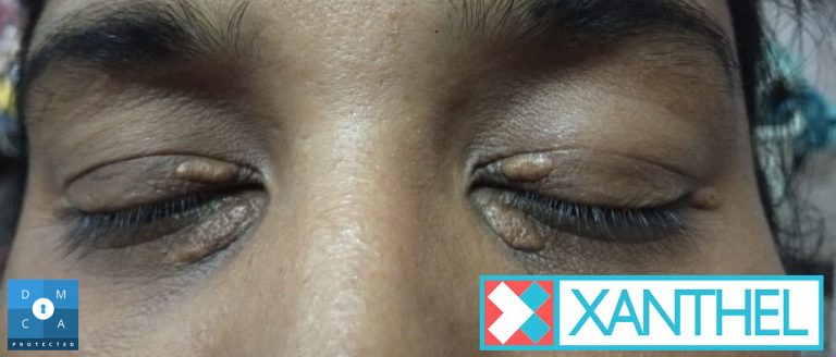 Xanthelasma Photo Gallery | Pictures by Xanthel®