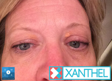 Xanthelasma Bilder und Bilder