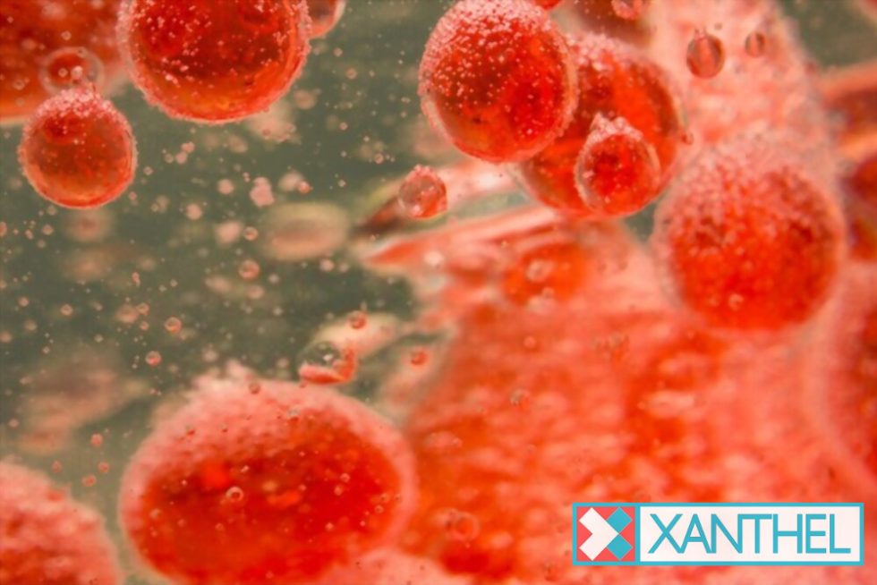 What Is Xanthelasma ? - Xanthelasma